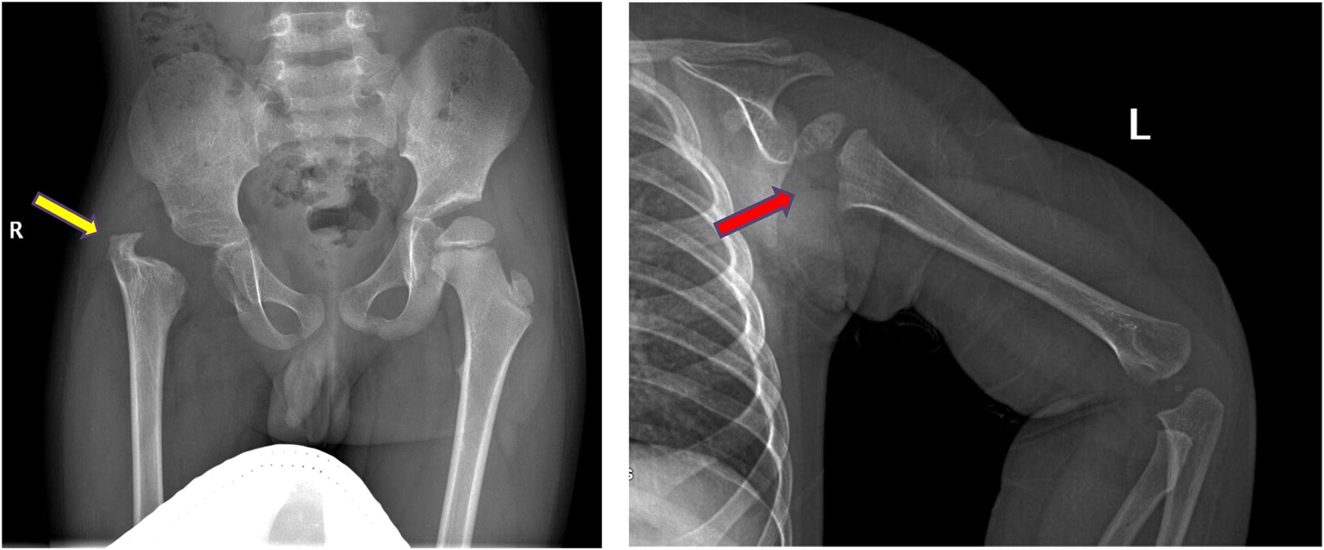 Bone and joint infection complicated with sepsis in neonates and ...
