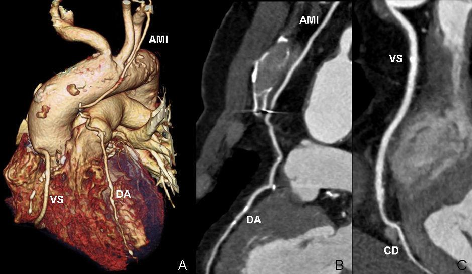 Aplicaciones clínicas de la coronariografía por tomografía ...