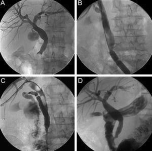 Litiasis de las vías biliares en manos del radiólogo intervencionista ...