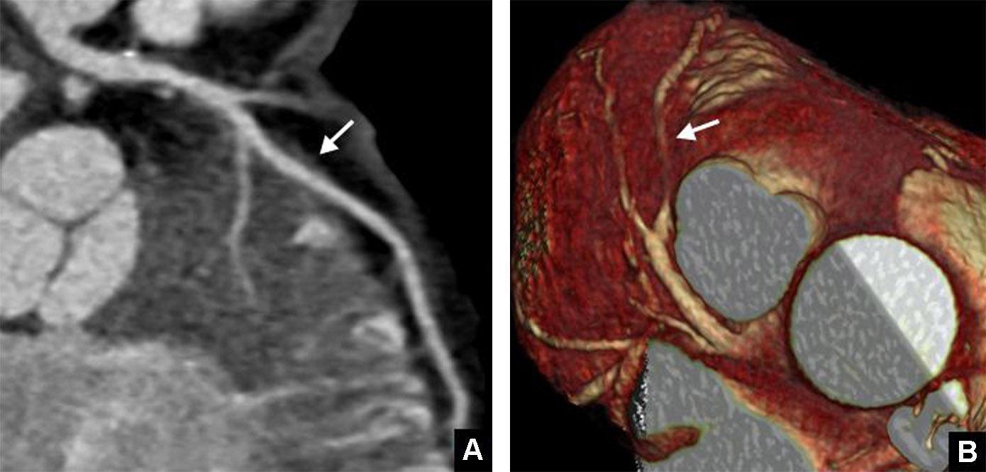 Tomografía computarizada de doble fuente en pacientes hospitalizados ...
