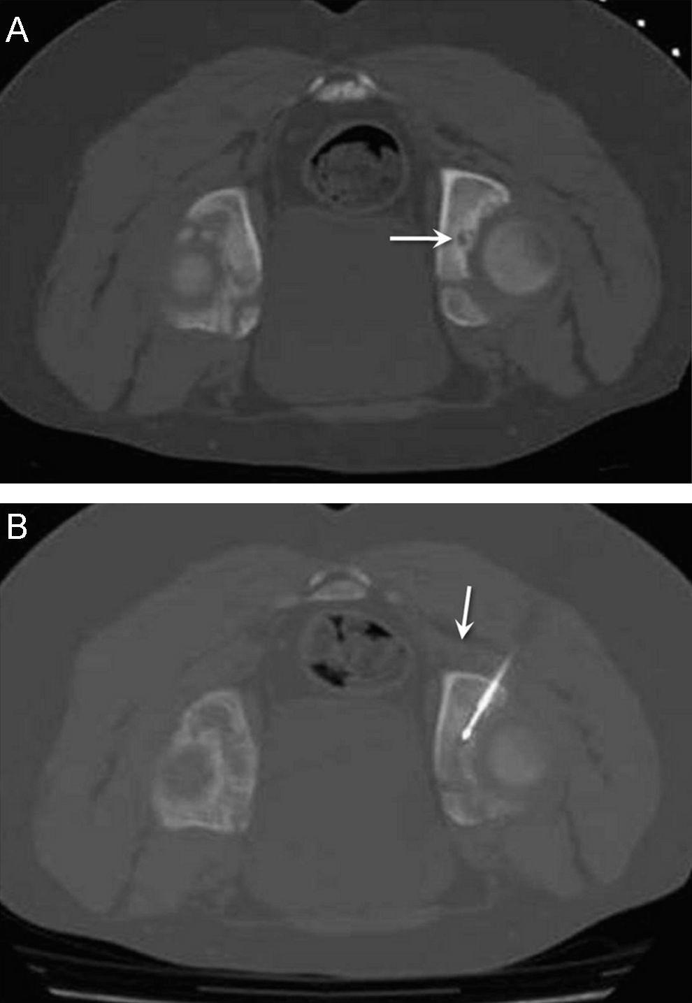 Tratamiento mediante radiofrecuencia percutánea de los tumores óseos ...