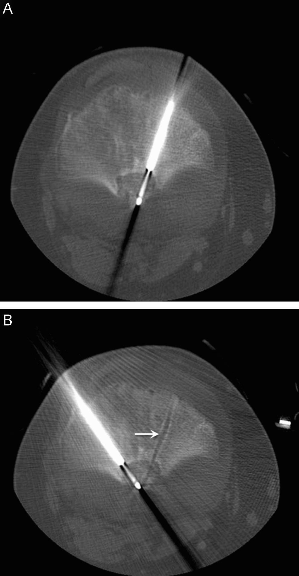 Tratamiento mediante radiofrecuencia percutánea de los tumores óseos ...