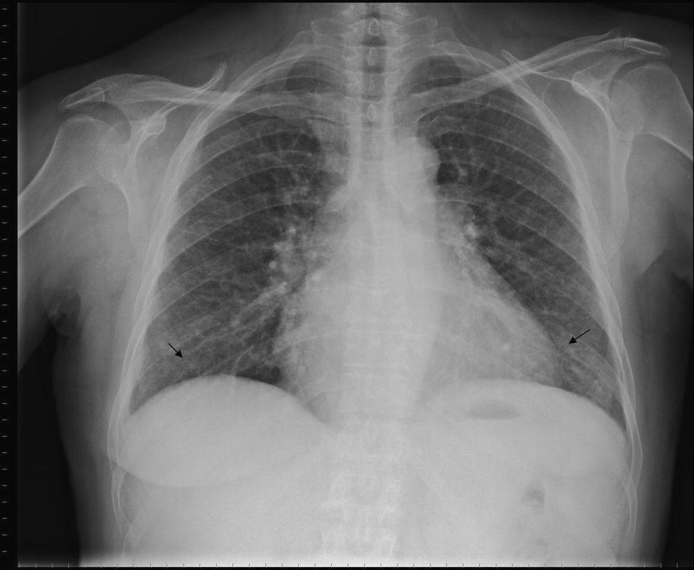 Meningoteliomatosis pulmonar difusa: causa infrecuente de patrón ...