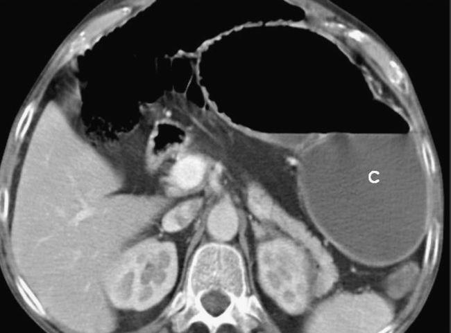 Patrón en mosaico de la pared del colon en un caso con vólvulo de ciego ...