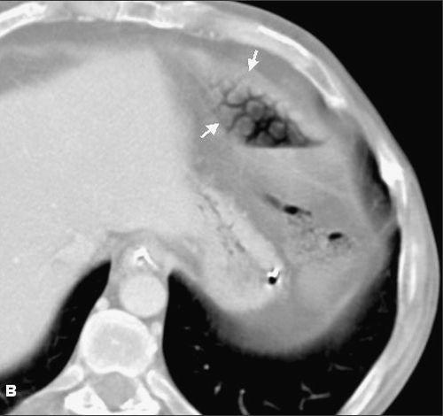 Patrón en mosaico de la pared del colon en un caso con vólvulo de ciego ...