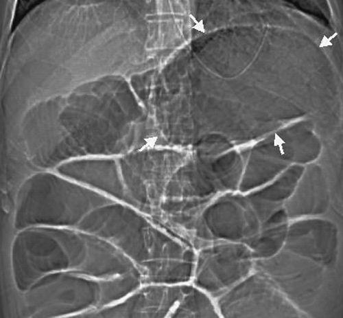 Patrón en mosaico de la pared del colon en un caso con vólvulo de ciego ...