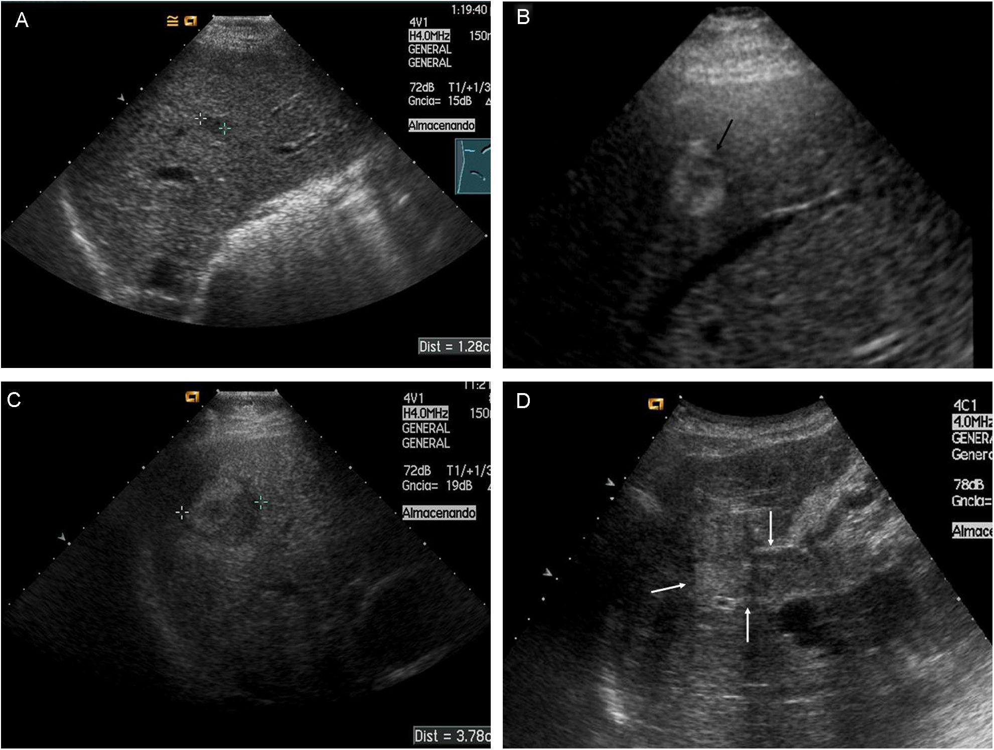 Carcinoma hepatocelular: diagnóstico, estadificación y estrategia ...