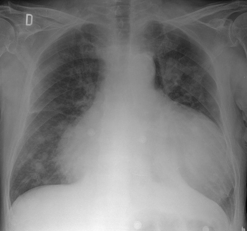 Abordaje radiológico del taponamiento cardiaco | Radiología