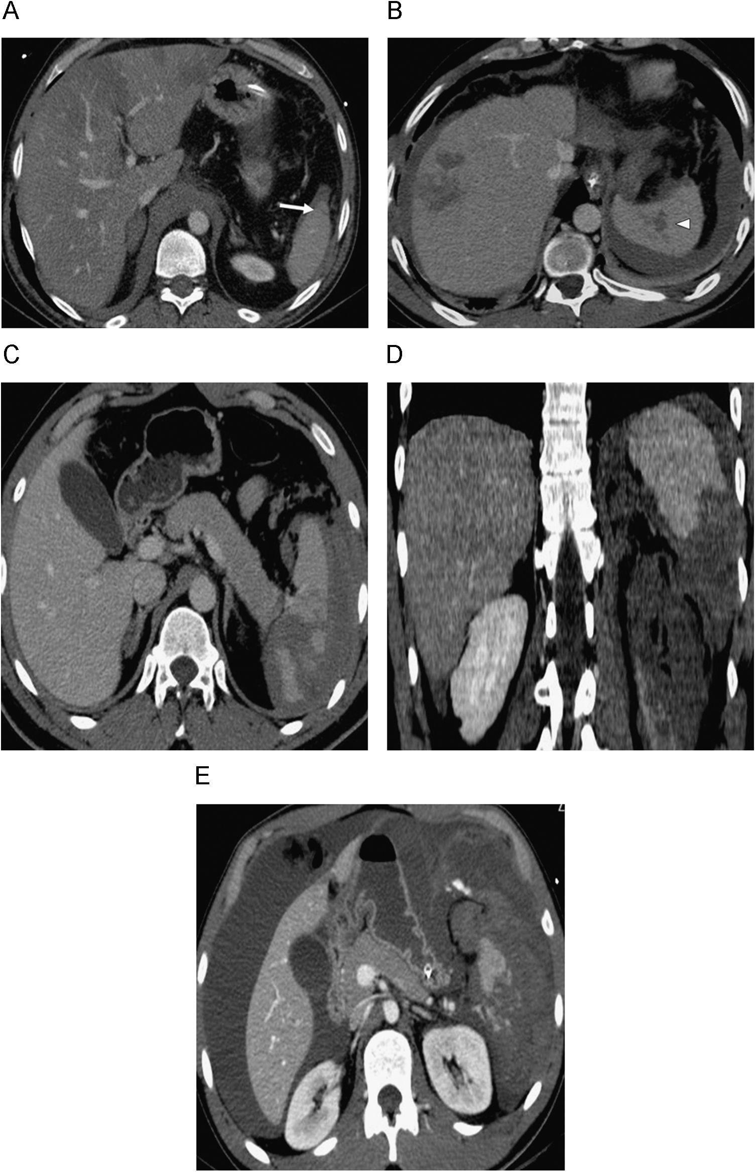 Manejo conservador de las lesiones esplénicas: experiencia en 136 ...