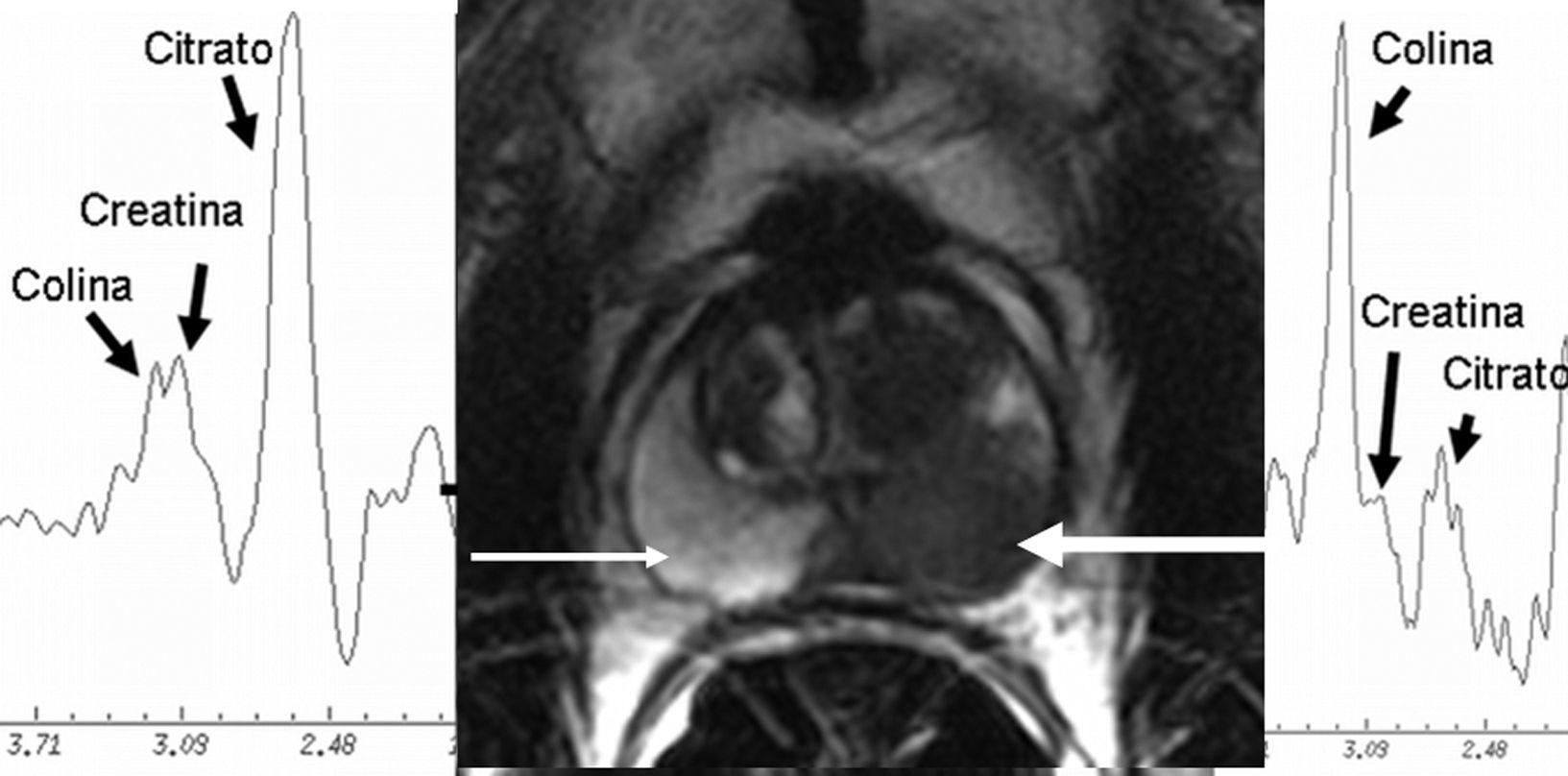 Utilidad de la resonancia magnética en el cáncer de próstata | Radiología