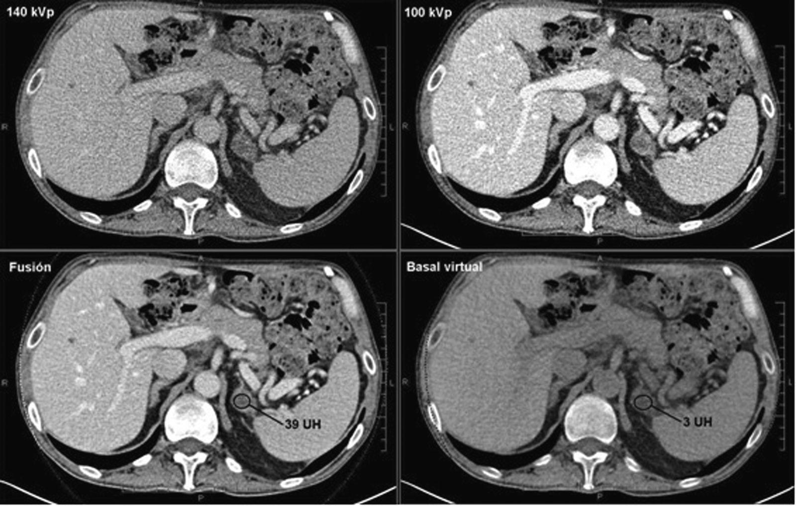 Manejo y diagnóstico del incidentaloma suprarrenal | Radiología