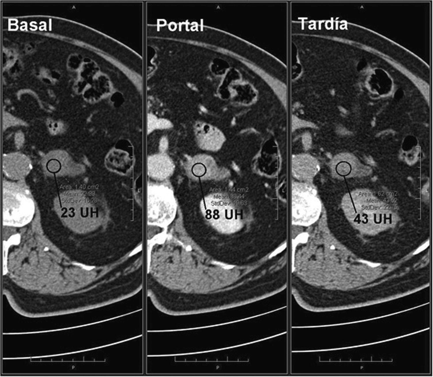 Manejo y diagnóstico del incidentaloma suprarrenal | Radiología