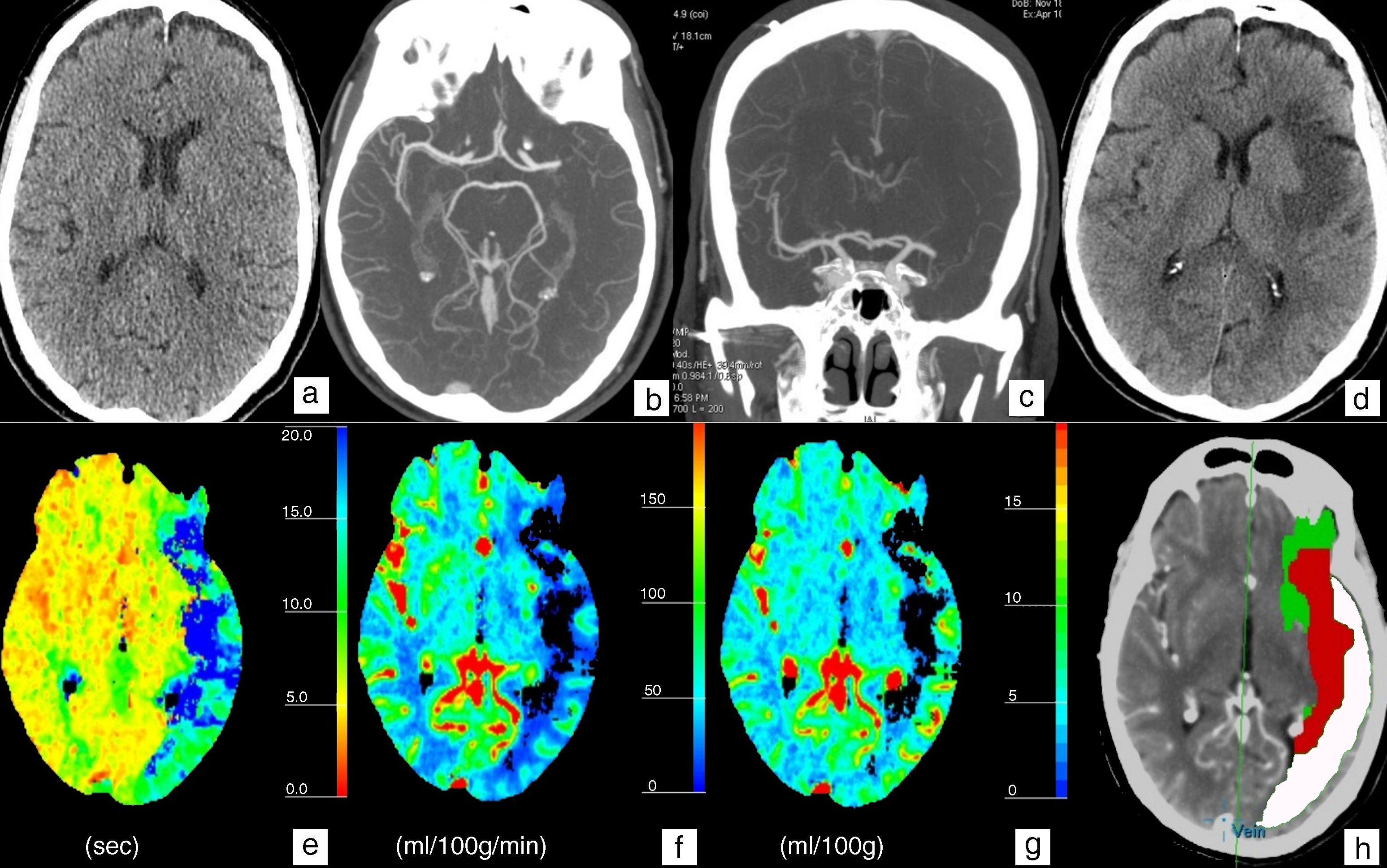 TC multimodal en el diagnóstico del código ictus | Radiología