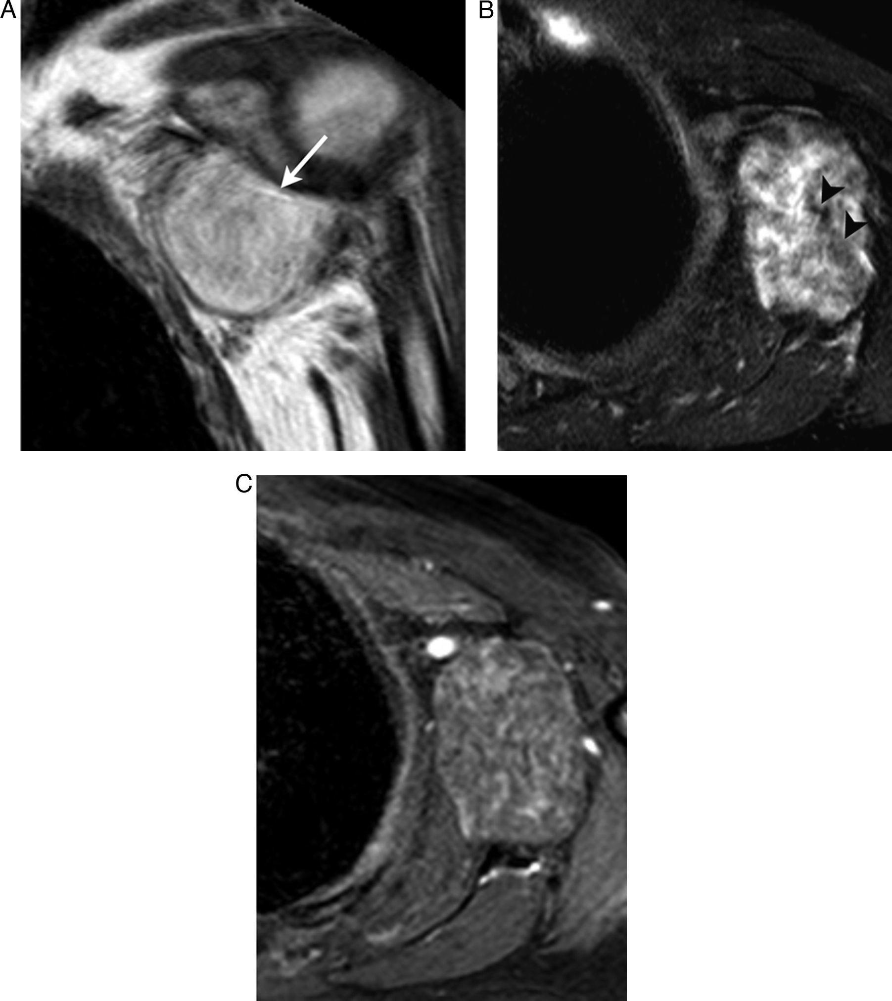 Tumores articulares y periarticulares: diagnóstico diferencial con ...
