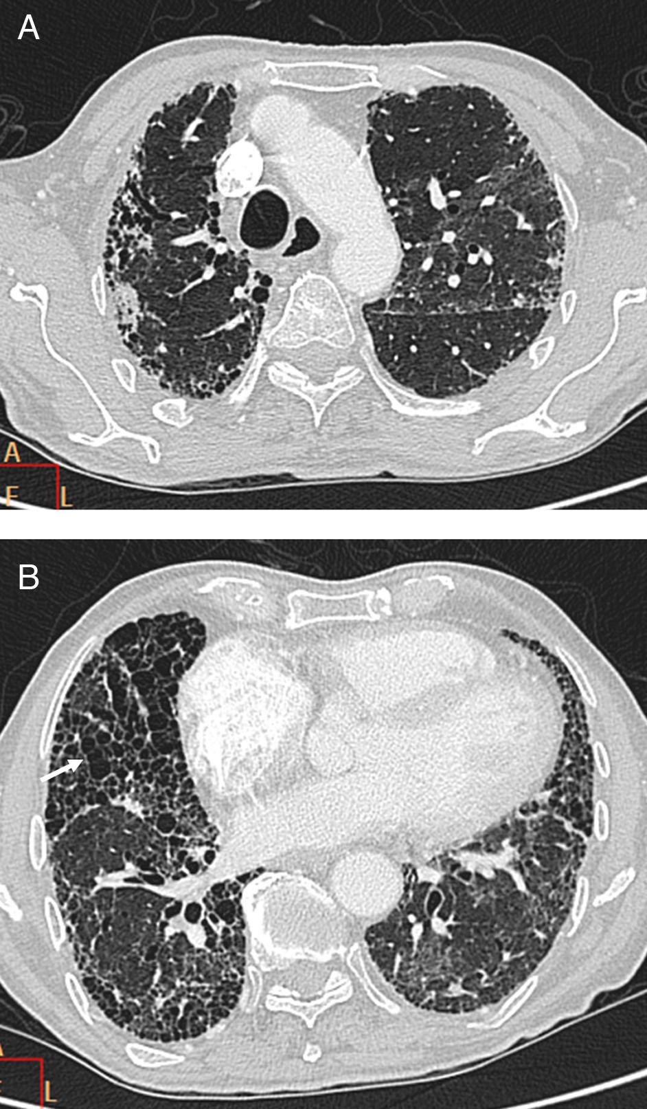Aproximación al diagnóstico radiológico de las neumonías intersticiales ...