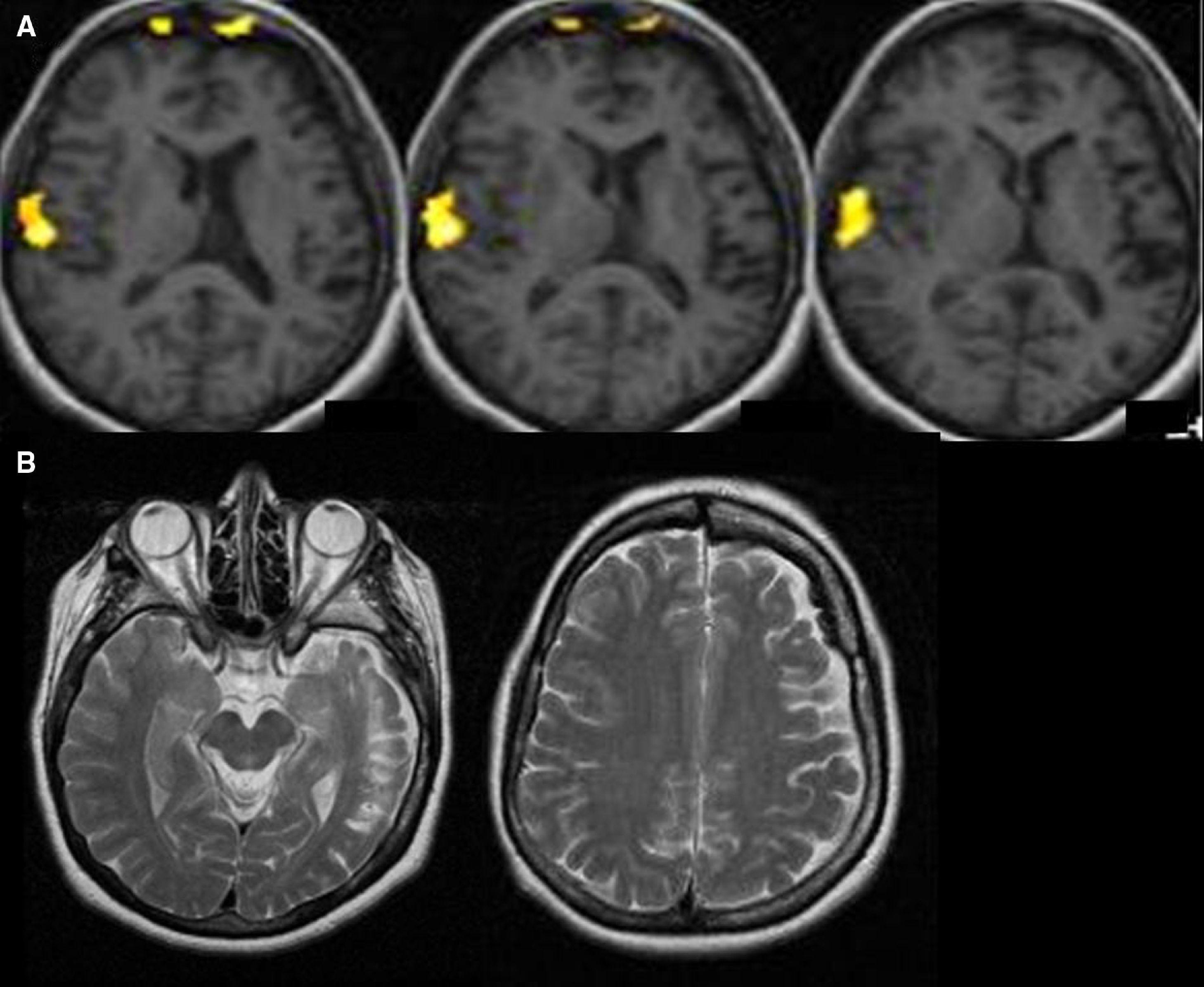 Imagen en epilepsia: estudios funcionales | Radiología