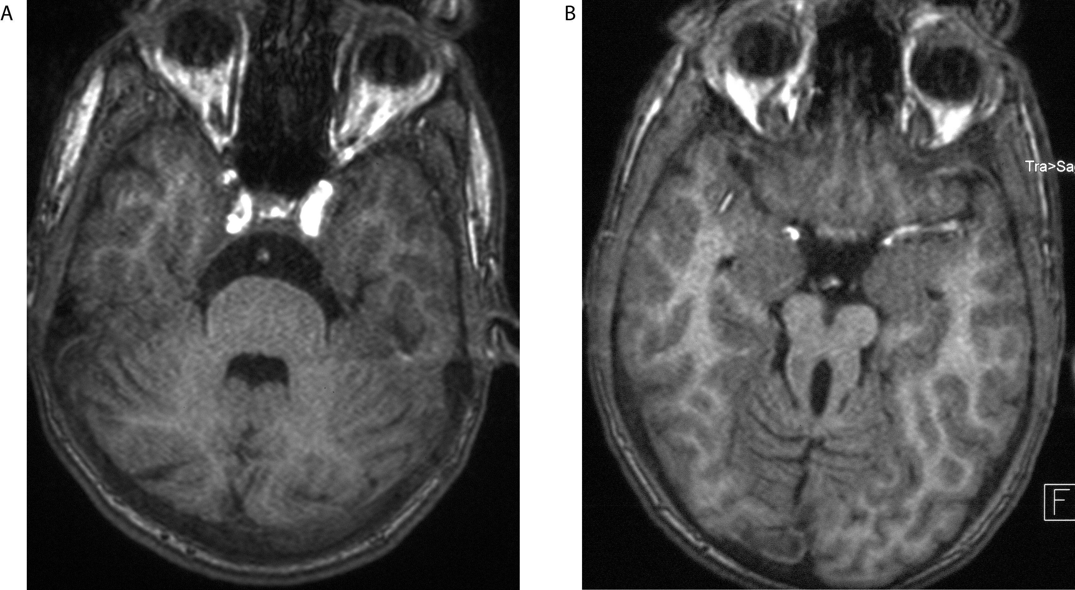 Síndrome de Joubert: hallazgos en resonancia magnética convencional y ...