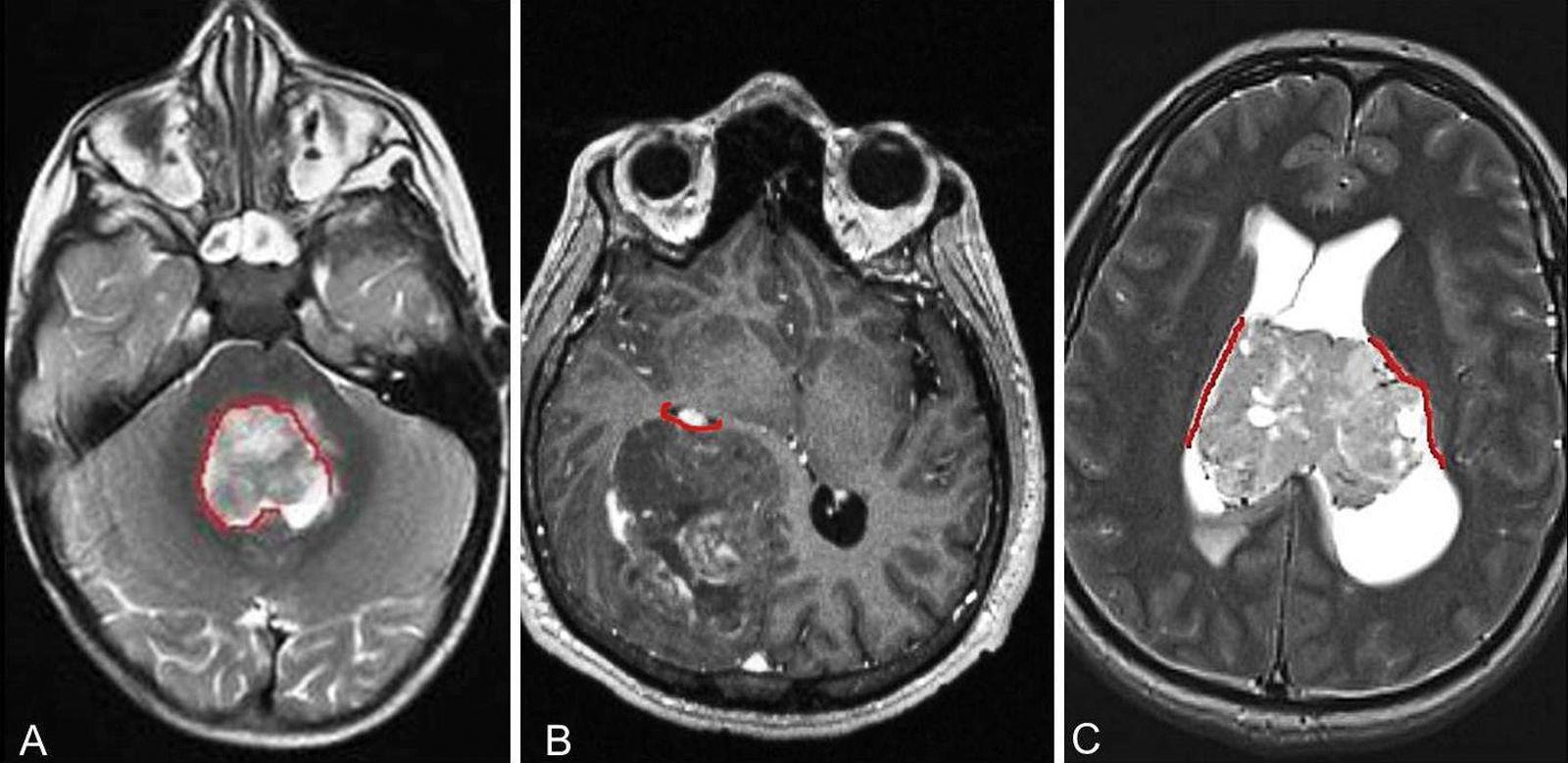 Células madre: implicaciones en el desarrollo de tumores cerebrales ...