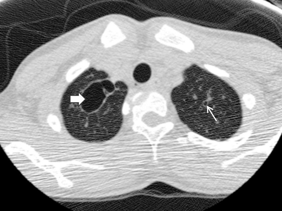 Fibrosis quística en imágenes. Clasificación de Bhalla para la ...