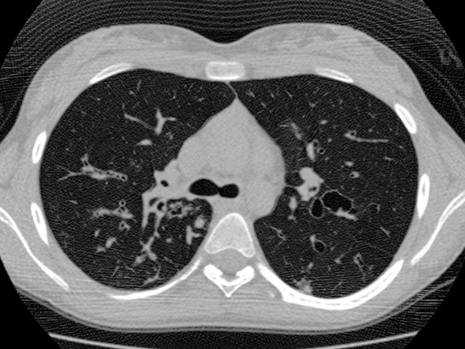 Fibrosis quística en imágenes. Clasificación de Bhalla para la tomografía computarizada en ...