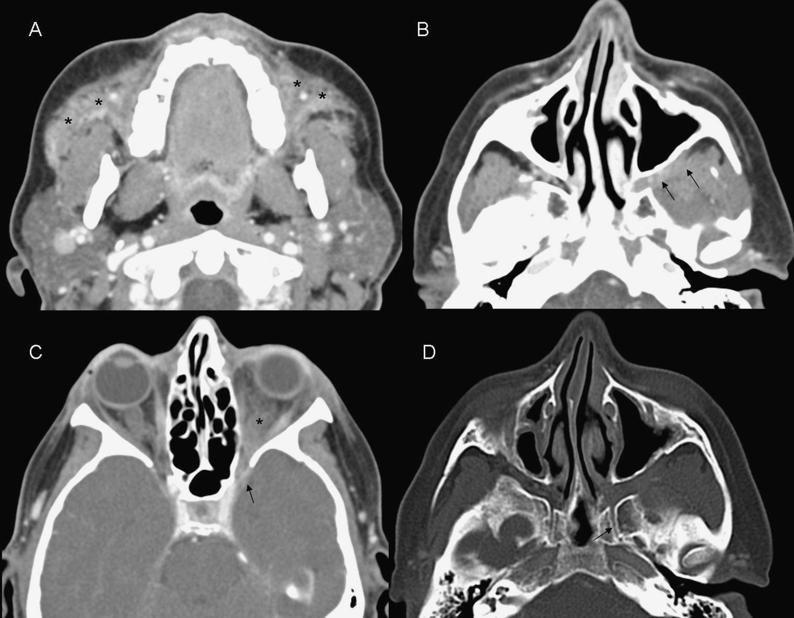 Solución del caso 42. Linfoma multifocal facial y orbitario | Radiología