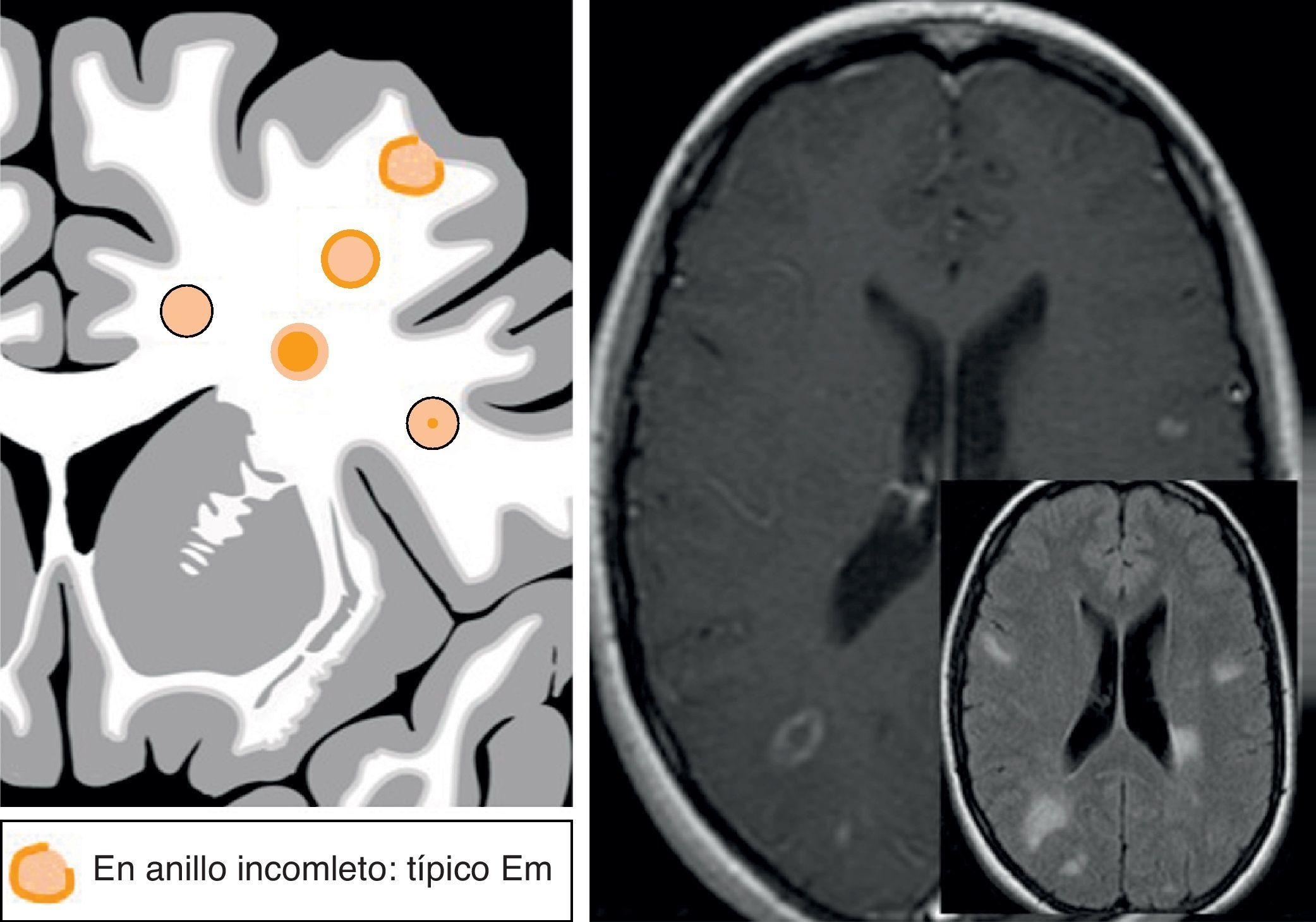 Imágenes puntiformes hiperintensas en la sustancia blanca: una ...