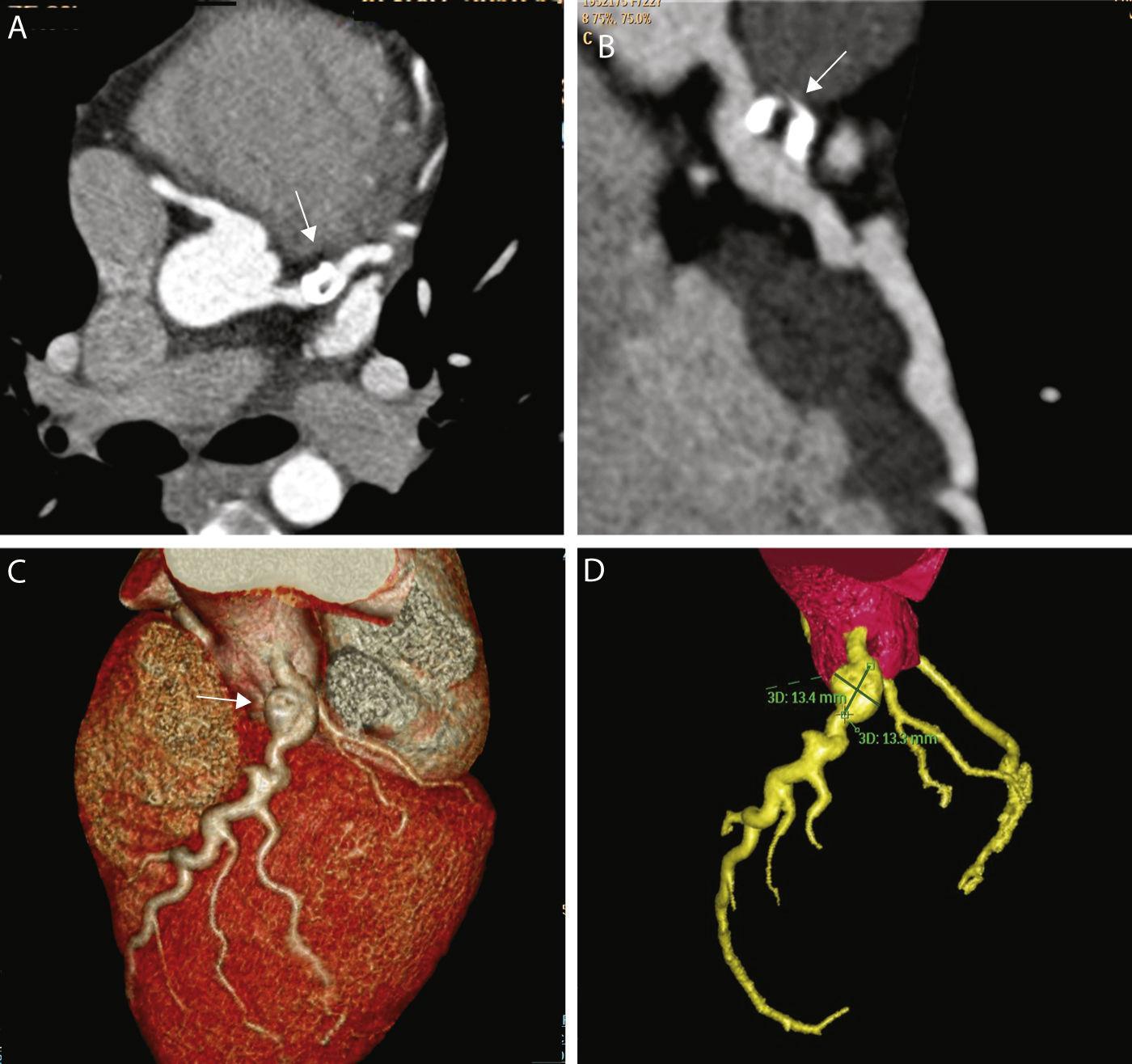 Técnicas de imagen no invasivas para el estudio de los aneurismas ...