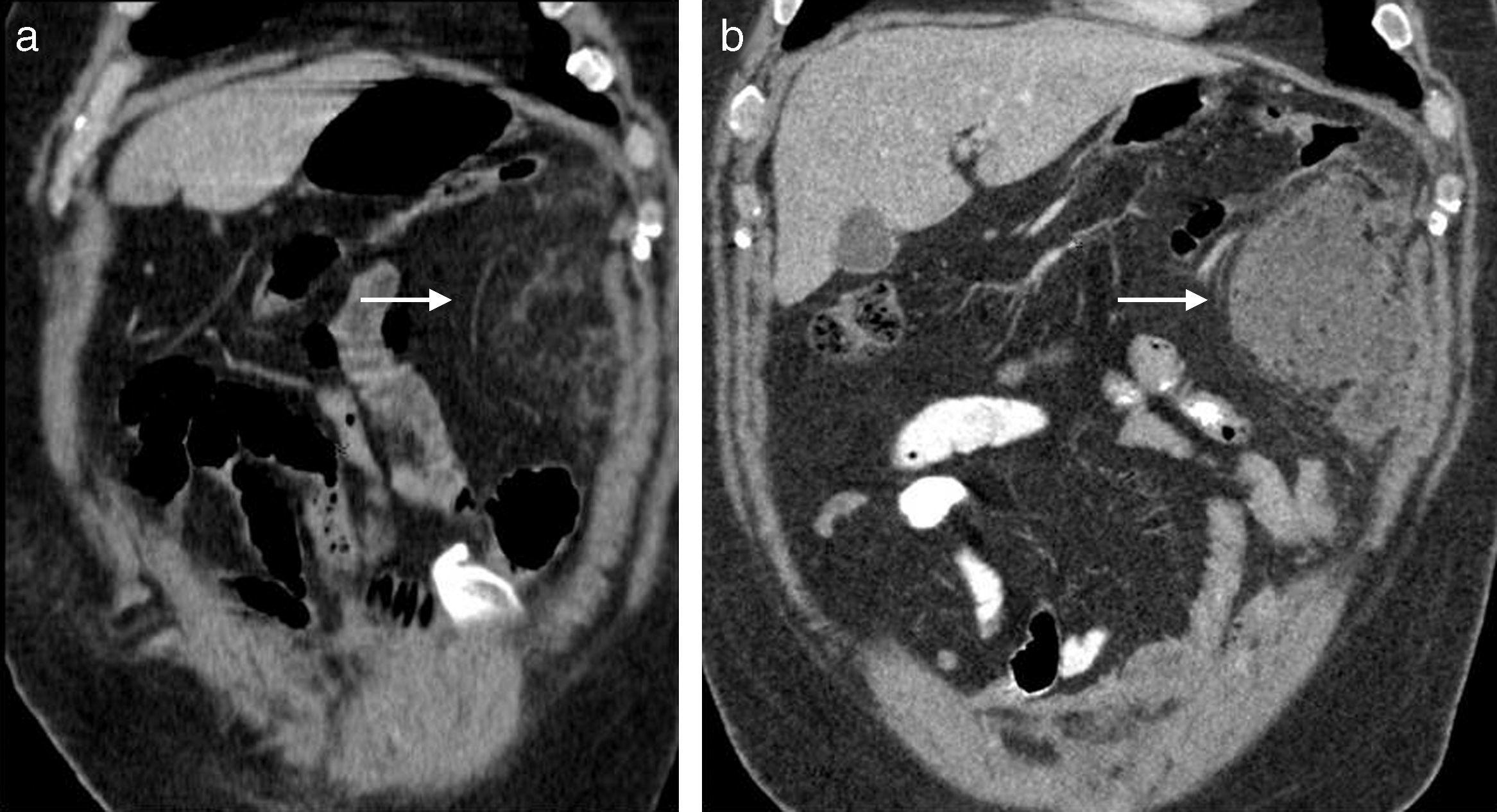 Necrosis grasa intraabdominal | Radiología