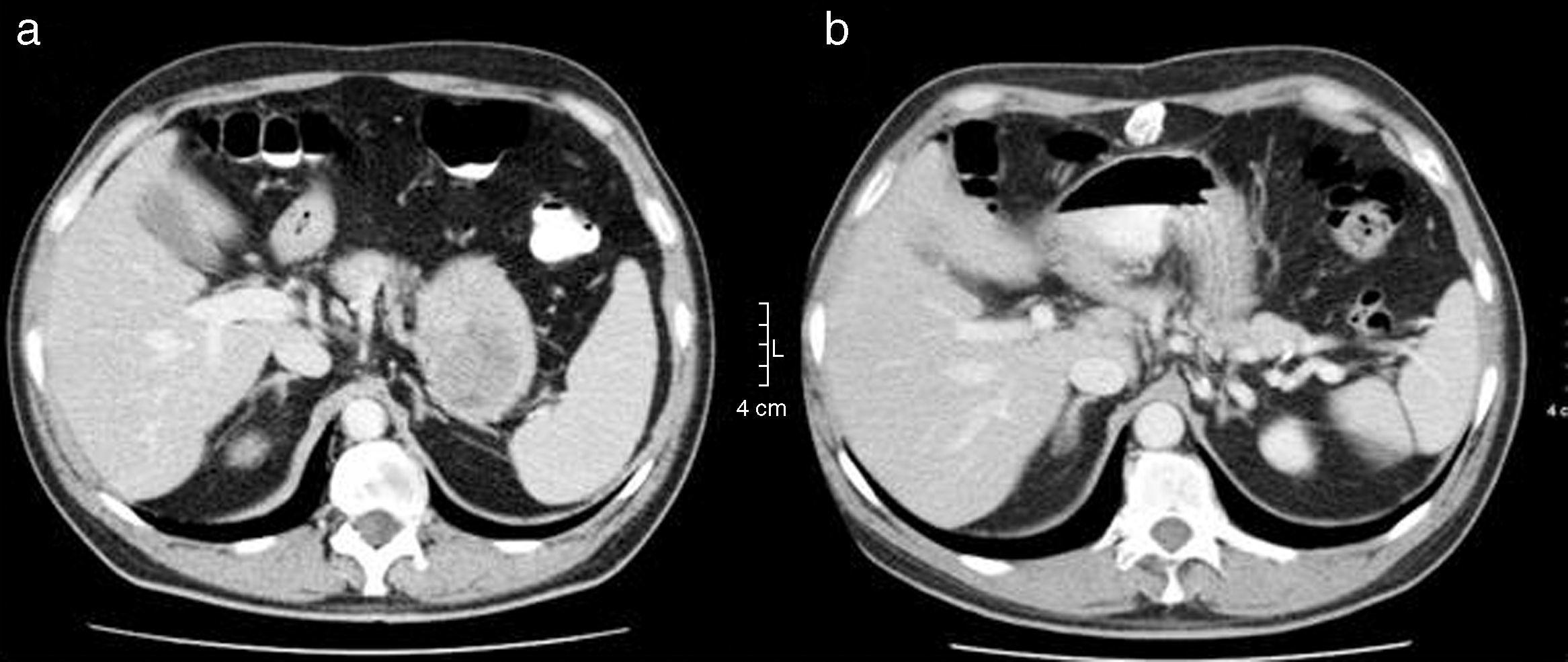 Necrosis grasa intraabdominal | Radiología