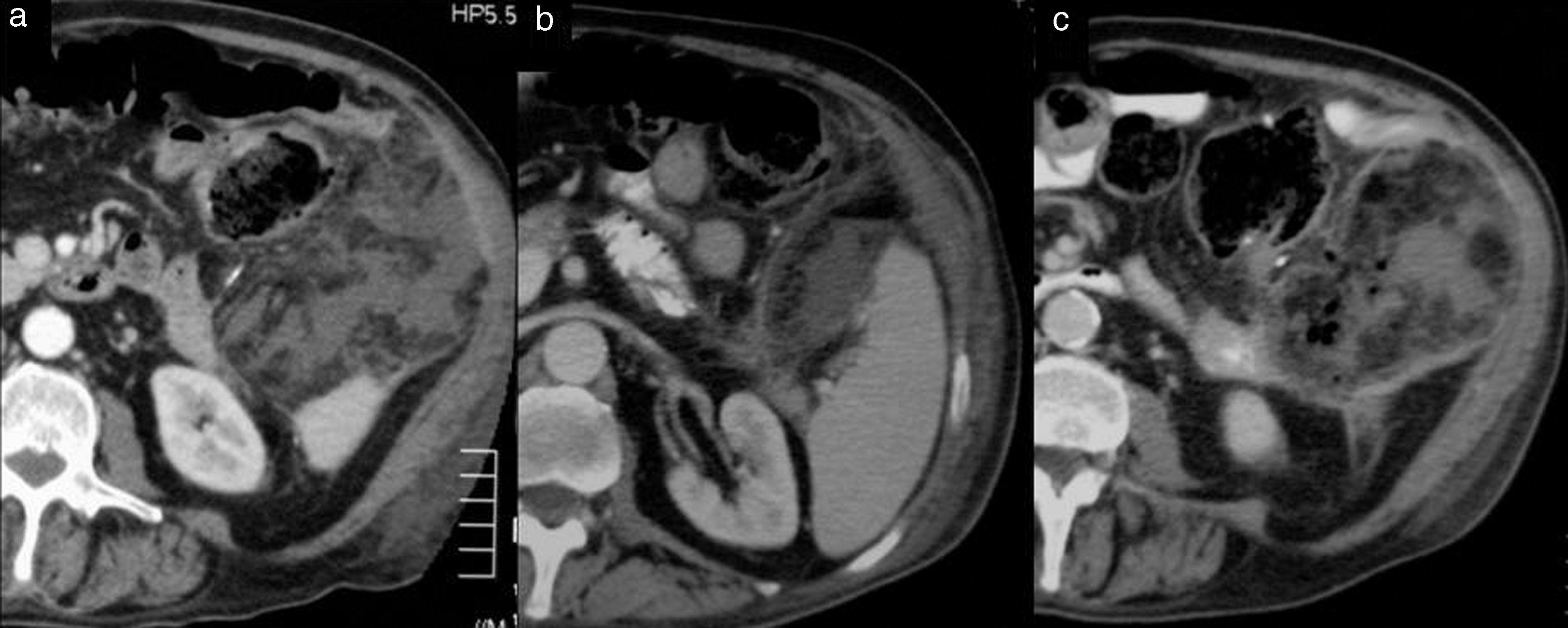 Necrosis grasa intraabdominal | Radiología