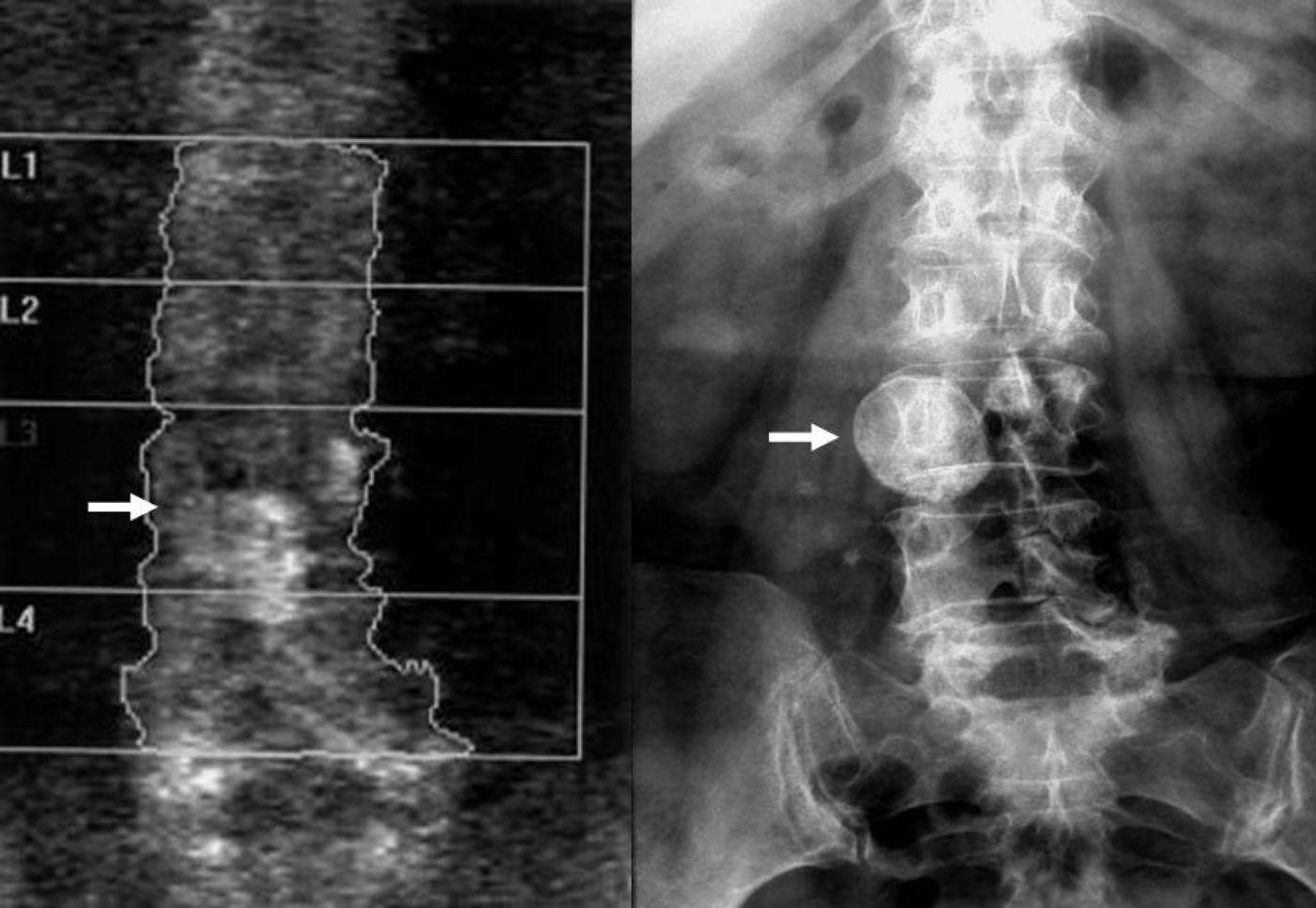 Absorciometría con rayos X de doble energía. Fundamentos, metodología y ...