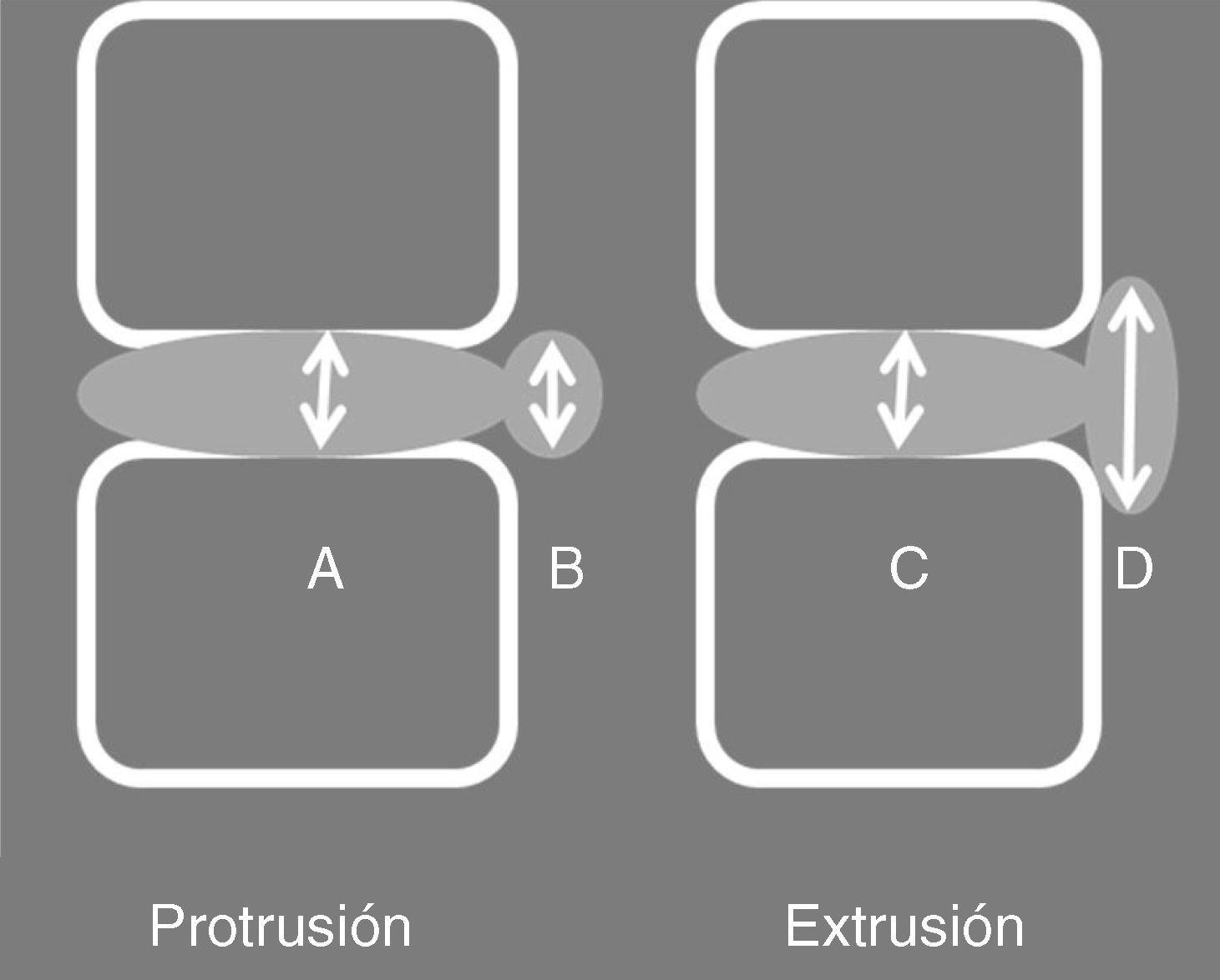 Nomenclatura estandarizada de la patología discal | Radiología