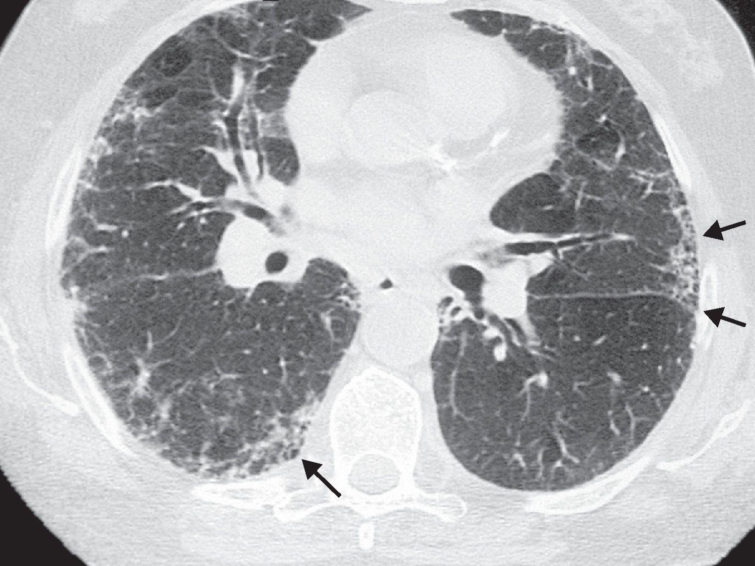 Neumonías intersticiales idiopáticas | Radiología