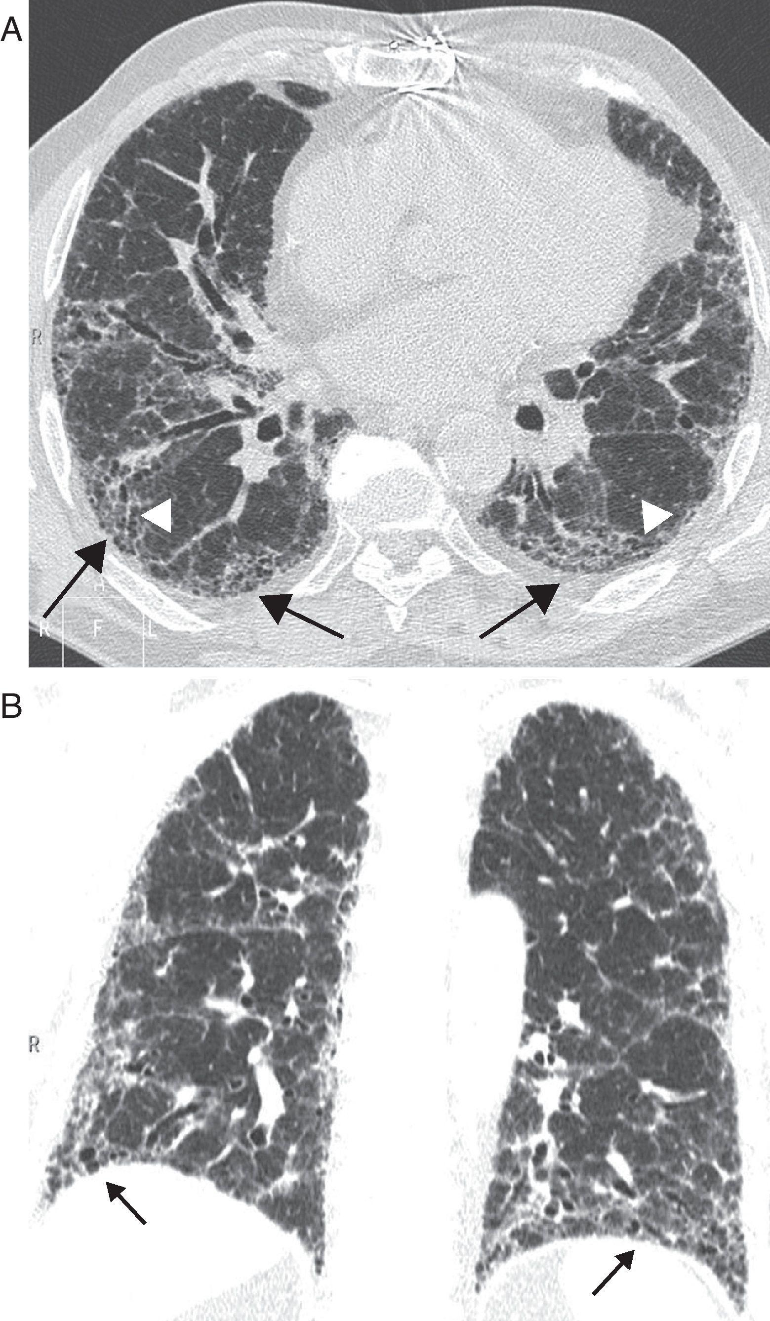 Neumonías intersticiales idiopáticas | Radiología