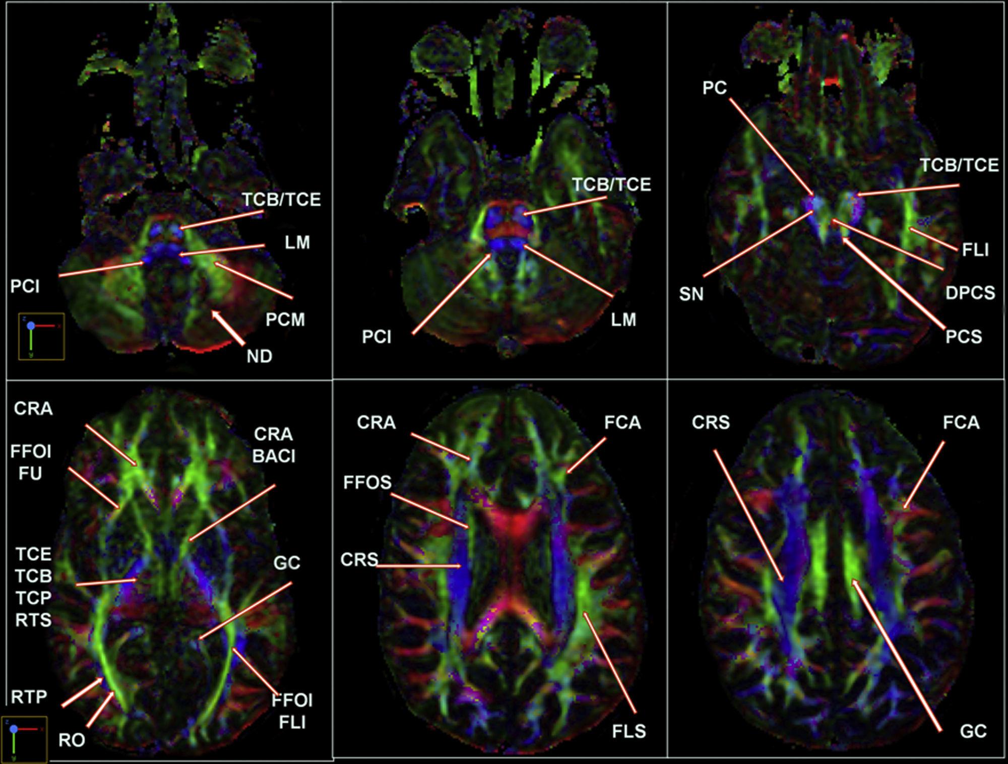 Imagen de tractografía 3T: anatomía y aplicaciones clínicas | Radiología