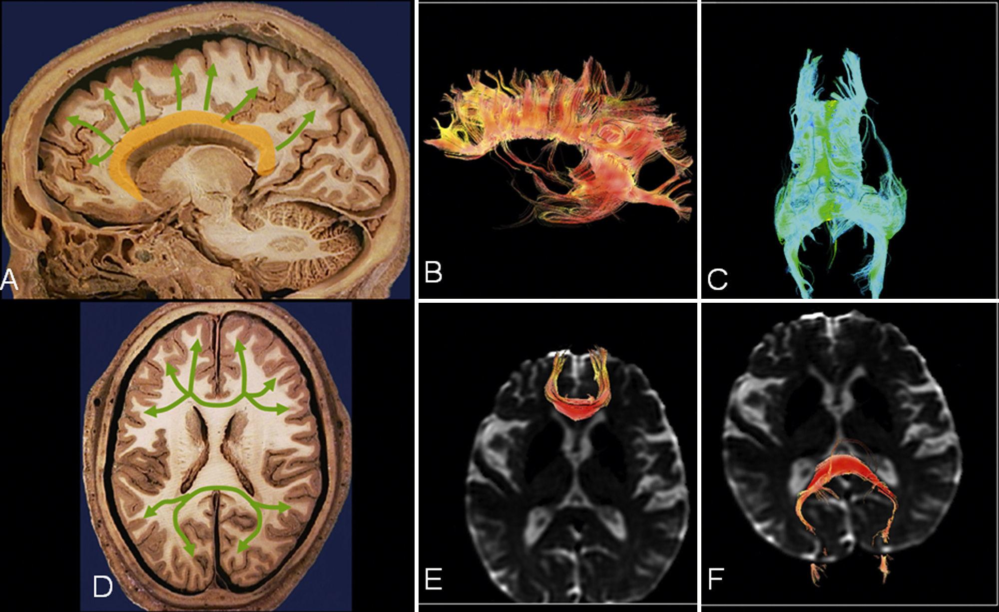 Imagen de tractografía 3T: anatomía y aplicaciones clínicas | Radiología