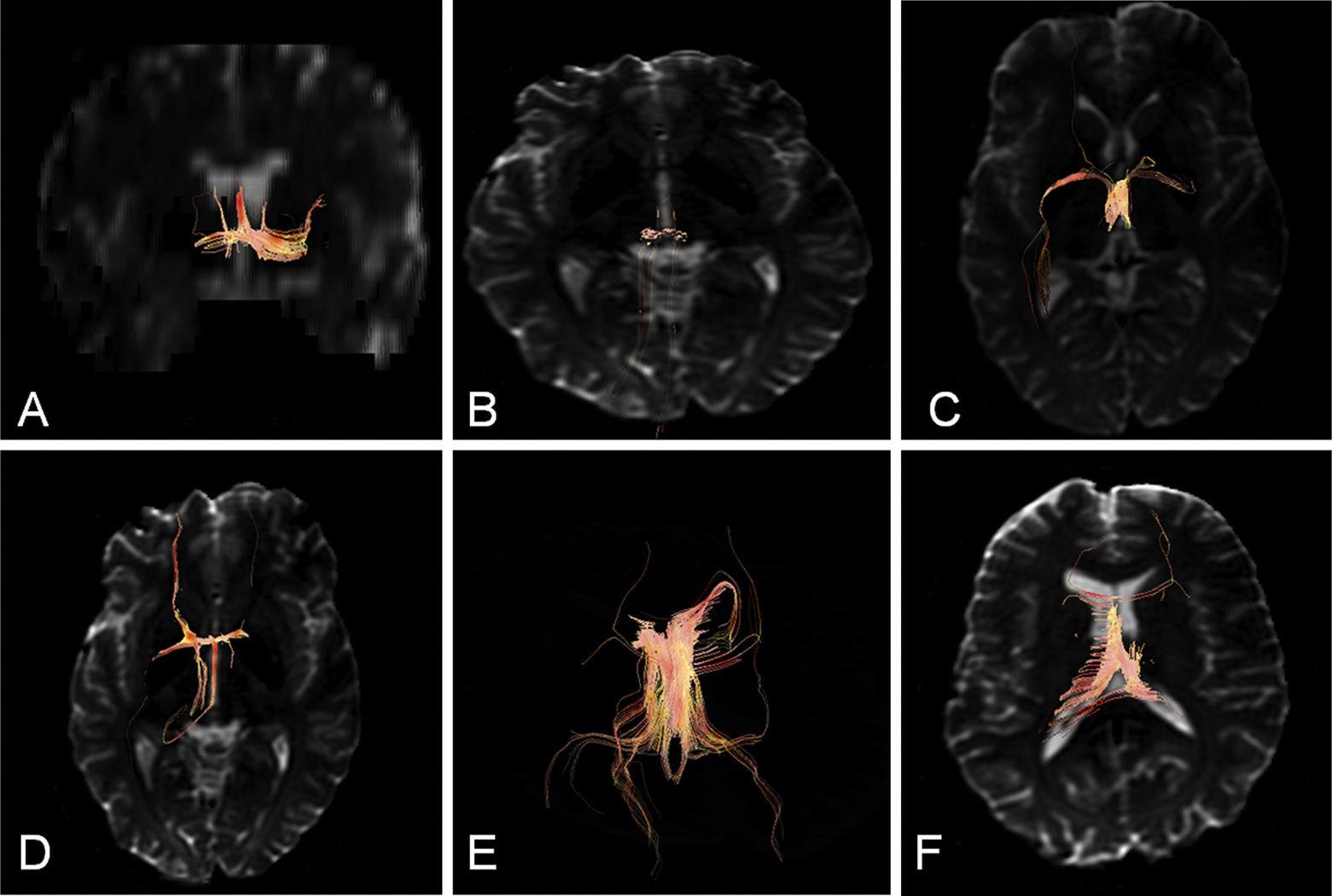 Imagen de tractografía 3T: anatomía y aplicaciones clínicas | Radiología