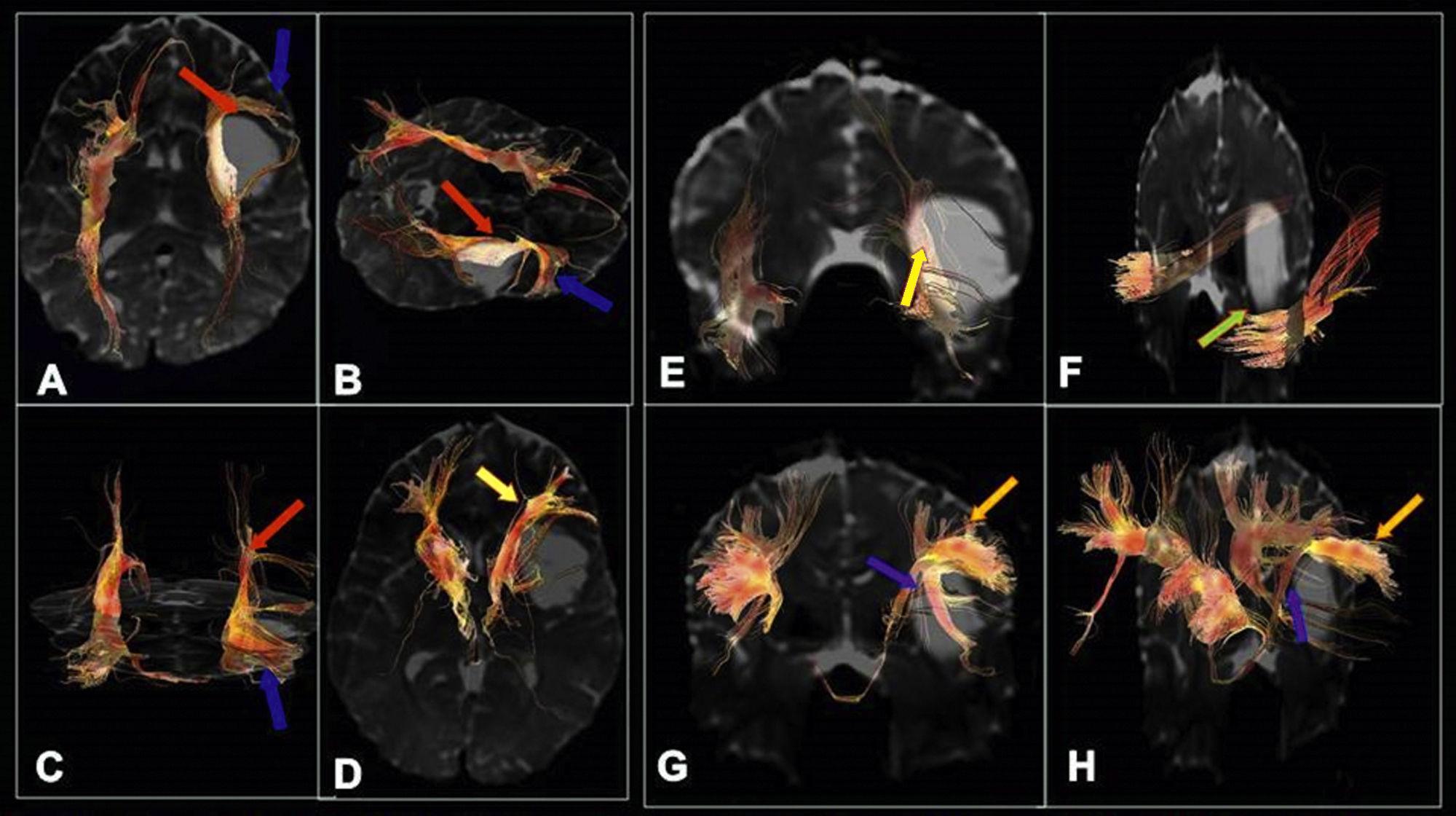 Imagen de tractografía 3T: anatomía y aplicaciones clínicas | Radiología