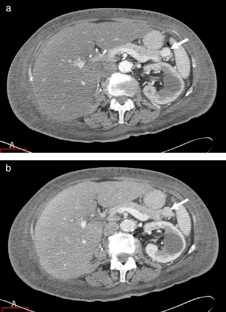 Presentación radiológica mediante TCMD de las metástasis pancreáticas ...