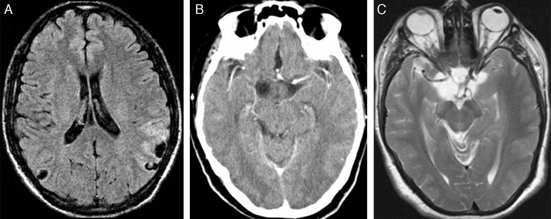 Neurocisticercosis. Hallazgos radiológicos | Radiología