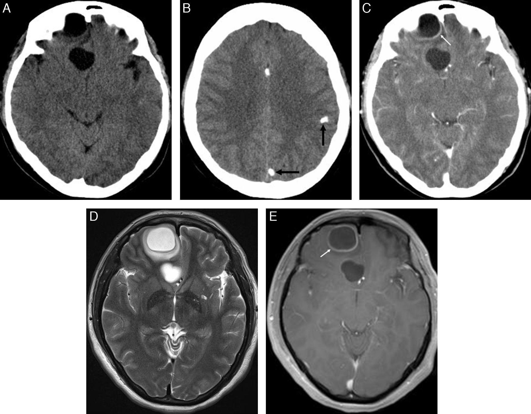 Neurocisticercosis. Hallazgos radiológicos | Radiología