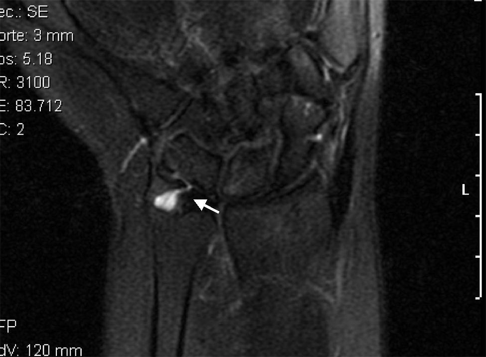 Análisis del manejo de fracturas ocultas de escafoides mediante la ...
