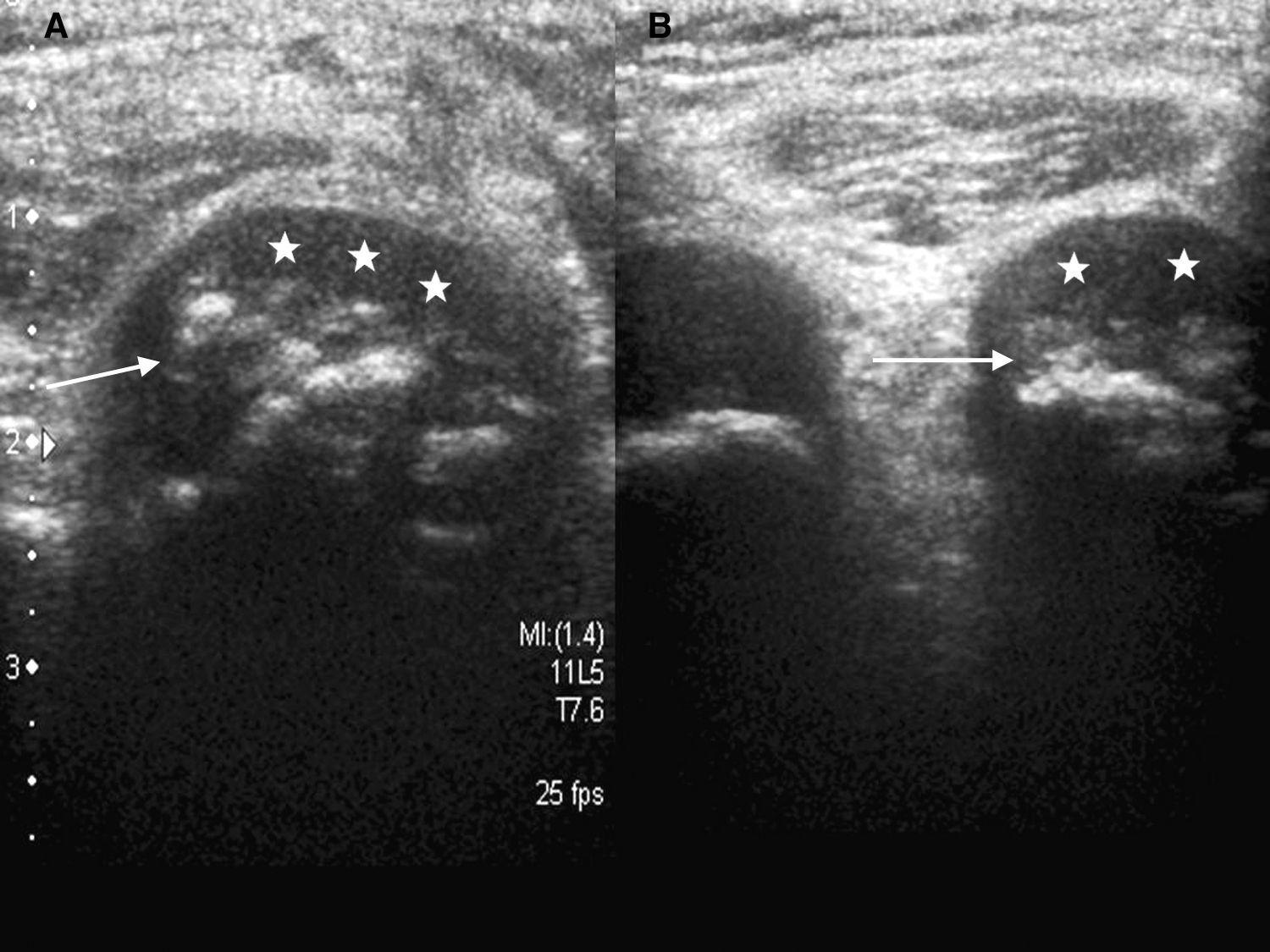 Solución del caso 50. Displasia epifisaria hemimélica | Radiología
