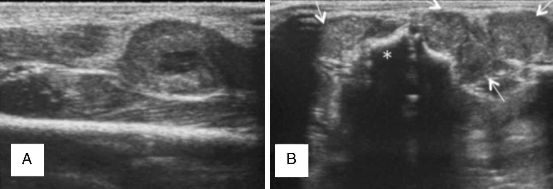 Miofibromatosis infantil. Un caso estudiado con ecografía y resonancia ...