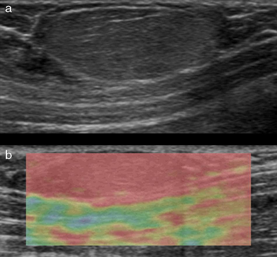 La elastografía: una nueva aplicación de la ecografía. ¿Cuál es su ...