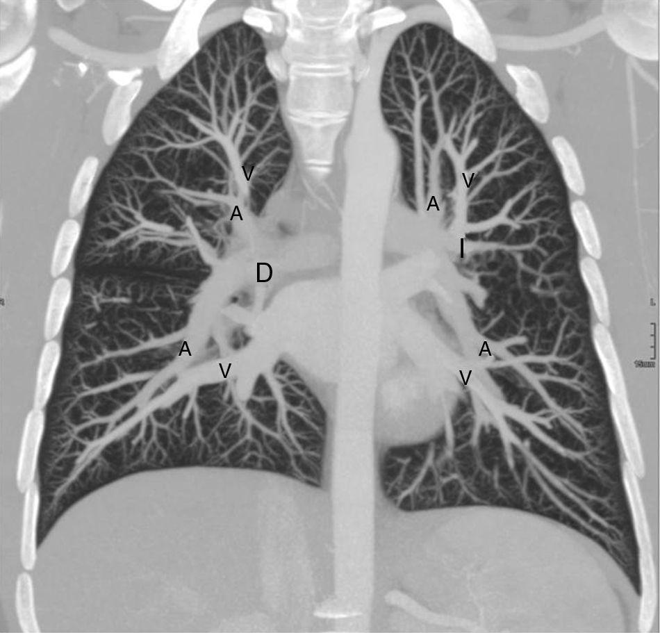 Los patrones de vascularización pulmonar en la radiografía simple de ...