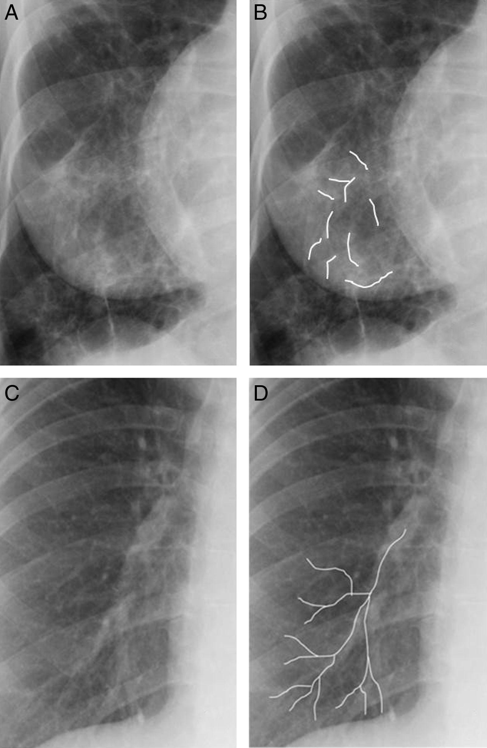 Los patrones de vascularización pulmonar en la radiografía simple de ...