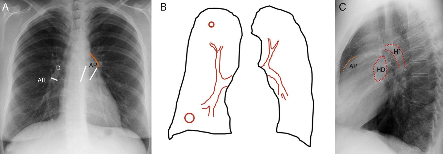 Los patrones de vascularización pulmonar en la radiografía simple de ...