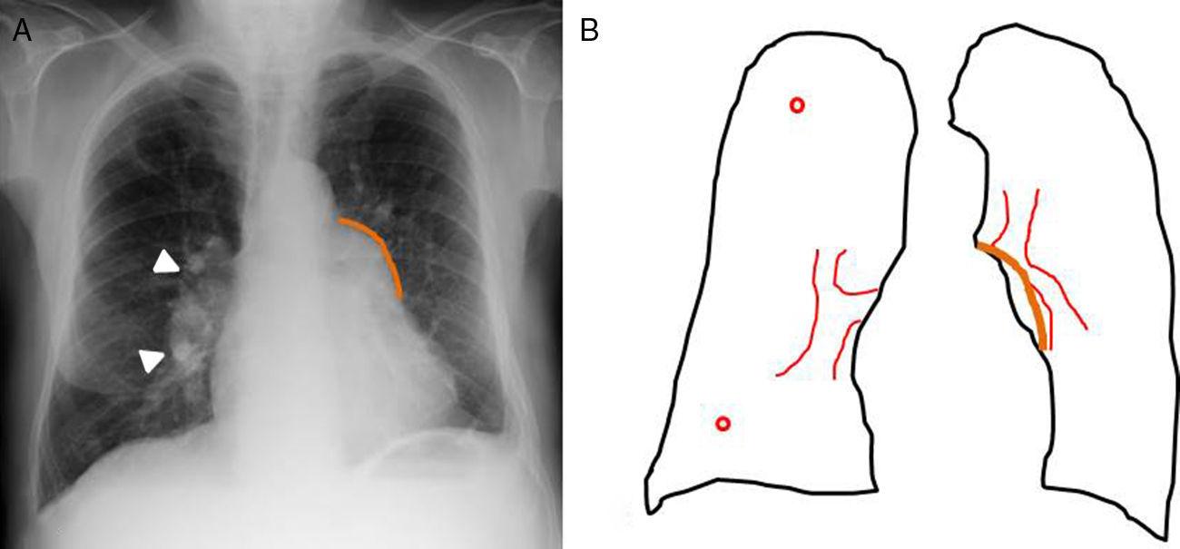 Los patrones de vascularización pulmonar en la radiografía simple de ...