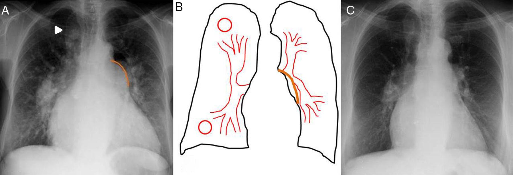 Los patrones de vascularización pulmonar en la radiografía simple de ...